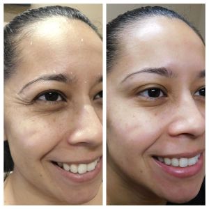 Cosmetic Injections - Meadows Eye Physicians & Surgeons