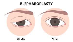 Dermatochalasis and Blepharoplasty - Meadows Eye Physicians & Surgeons