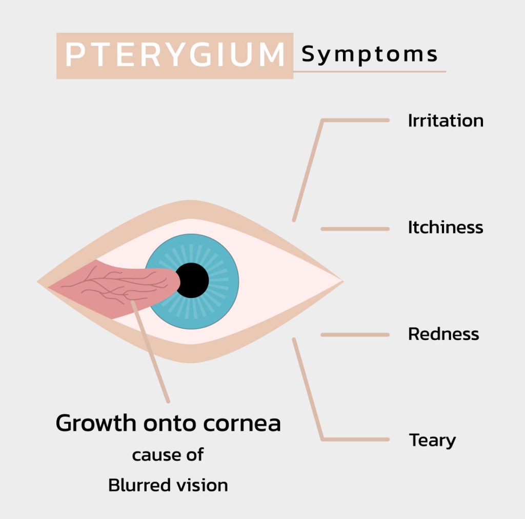 Pterygium Treatment: What You Need to Know - Meadows Eye