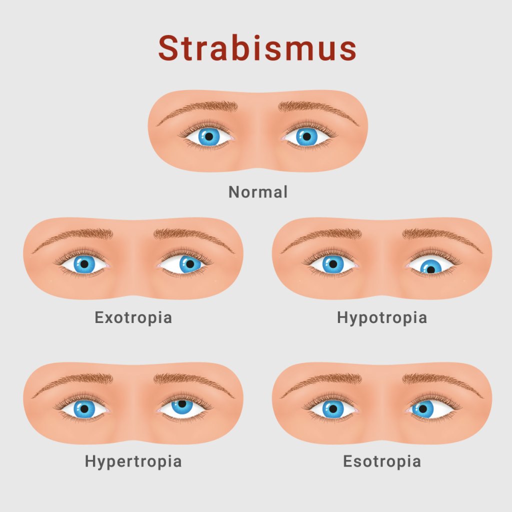 Strabismus: Understanding Eye Misalignment Issues